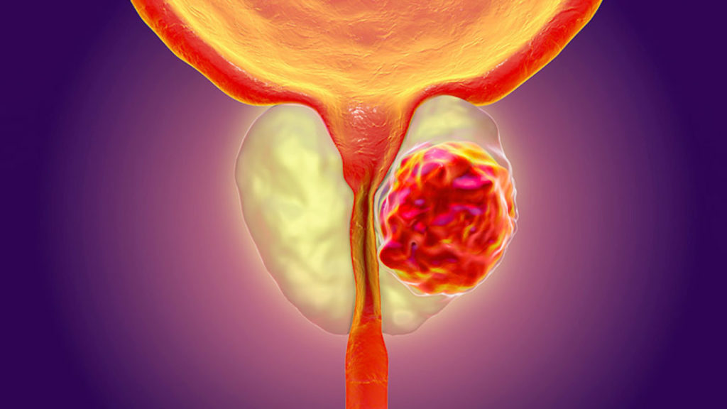 Prostate Cancer Treatment Pros And Cons You Should Know