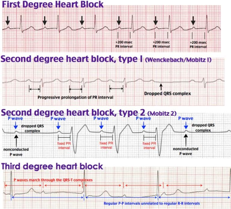 Commonly Found Symptoms of Heart Blockage in Males