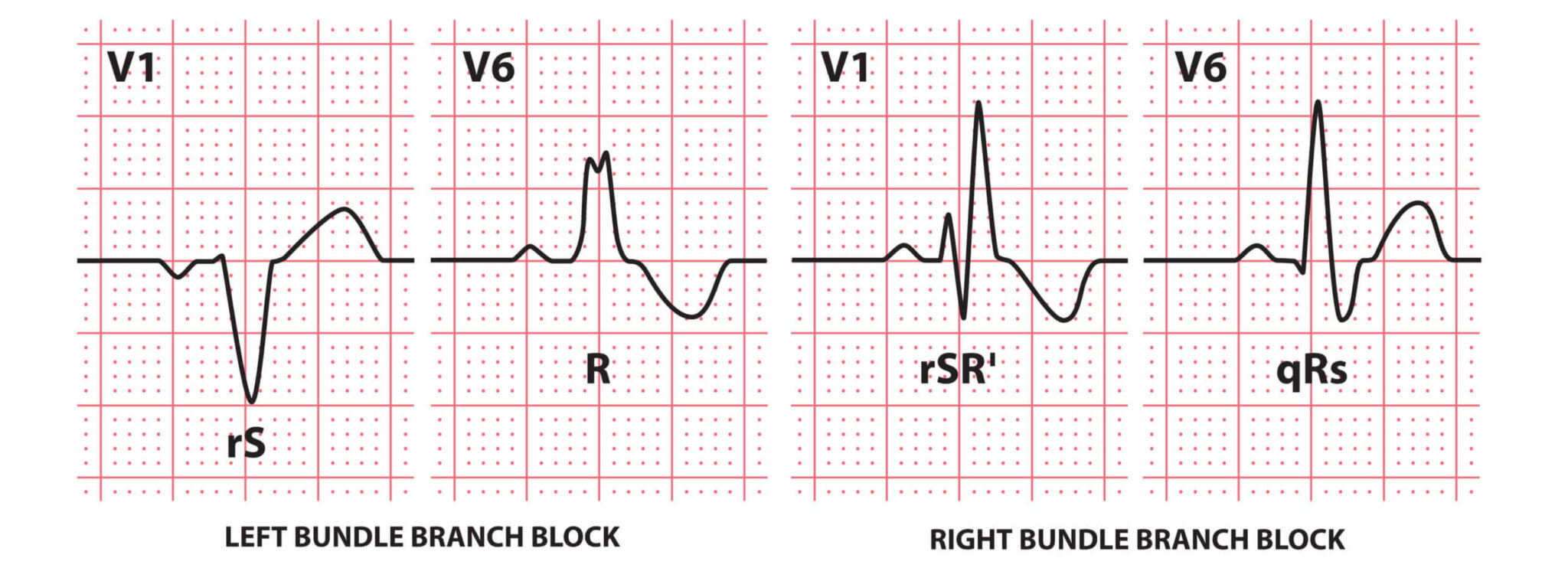Bundle Branch Block: What is it? Causes, Symptoms, Treatment