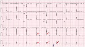 First Degree Heart Block – Not Serious, But You Need to Act