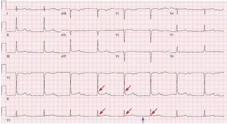 First Degree Heart Block – Not Serious, But You Need to Act