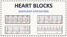 Heart Block: Types, Causes, Symptoms, Risks, Treatment