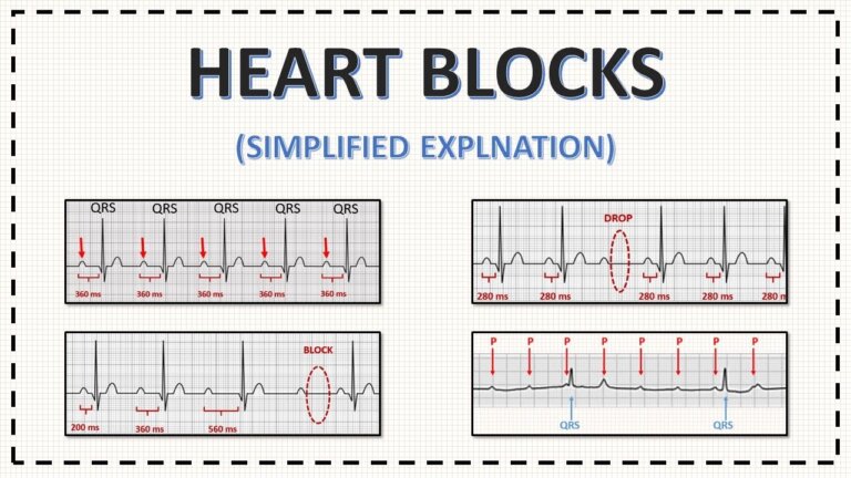 Heart Block: Types, Causes, Symptoms, Risks, Treatment Heart Block: Types, Causes, Symptoms, Risks, Treatment