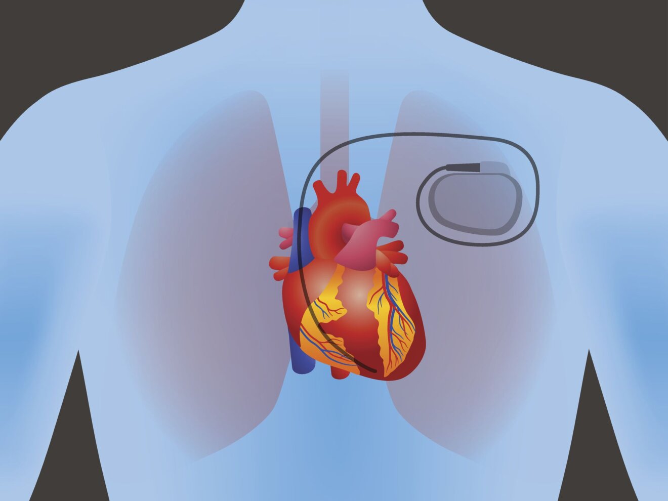 Second Degree Heart Block - How Heart Starts Skipping Beats