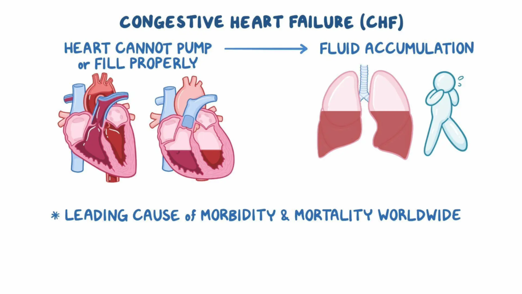 Congestive Heart Failure Causes, Stages, Symptoms, Treatment